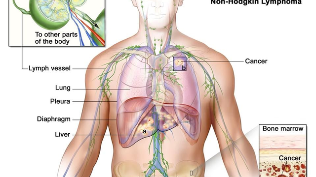 Doktor Ini Jelaskan Tanda-Tanda Diserang Kanser Limfoma | SINAR