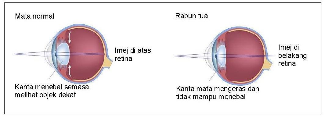 Apa Beza Rabun Jauh dan Rabun Dekat ? | ERA