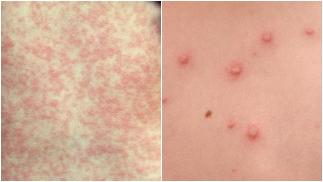 Chicken Pox vs Demam Campak, Apa Beza Dan Cara Rawatannya? | ERA