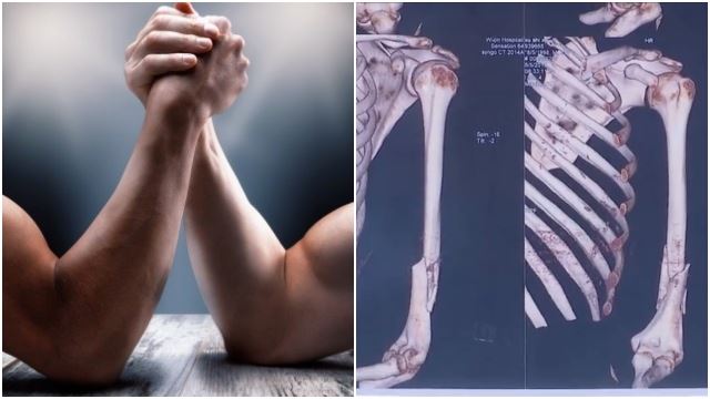 College Student Breaks And Bruises His Arm After An Arm-Wrestling Match ...