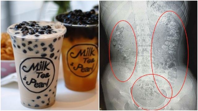 Teenage Girl Hospitalised After Doctors Found Hundreds Of Undigested ...