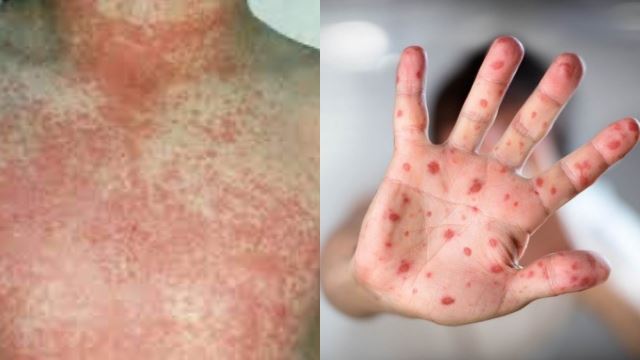 Badan Pesakit Akan Penuh Ruam, Britain Diancam Serangan Demam Scarlet ...