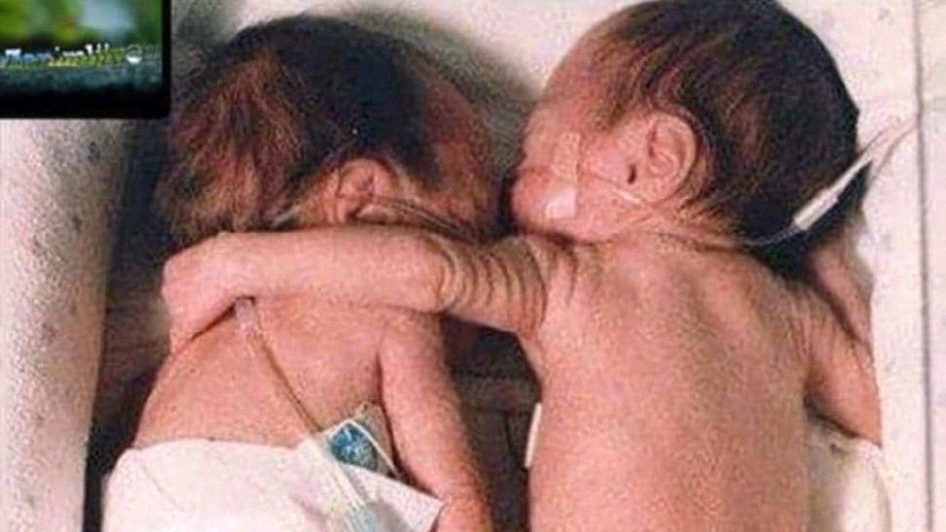 Pelukan yang Menyelamatkan, Kisah Bayi Kembar Pramatang yang Mengubah ...